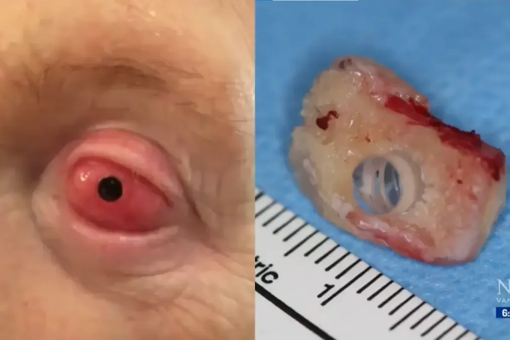 Vision Restored with a Tooth? Canada's Groundbreaking Eye Surgery Stuns ...