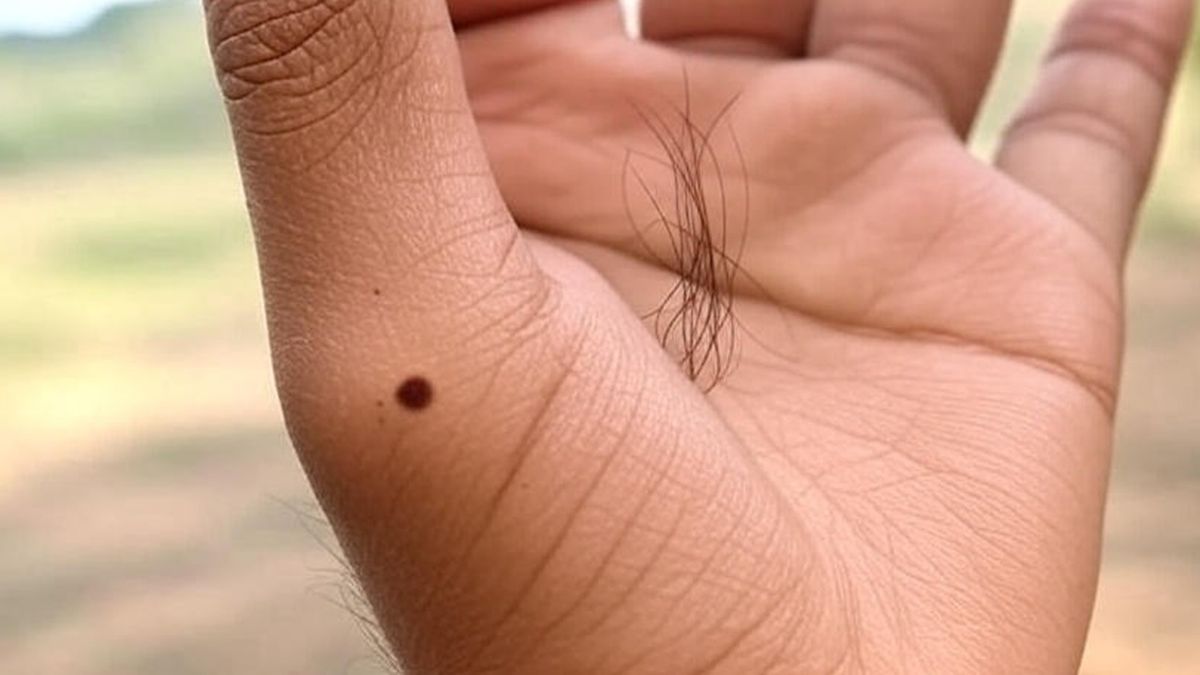Hair on Mole: আঁচিল বা তিলের ওপর চুল গজিয়েছে? কাটবেন না! ঘরোয়া উপায়ে ...