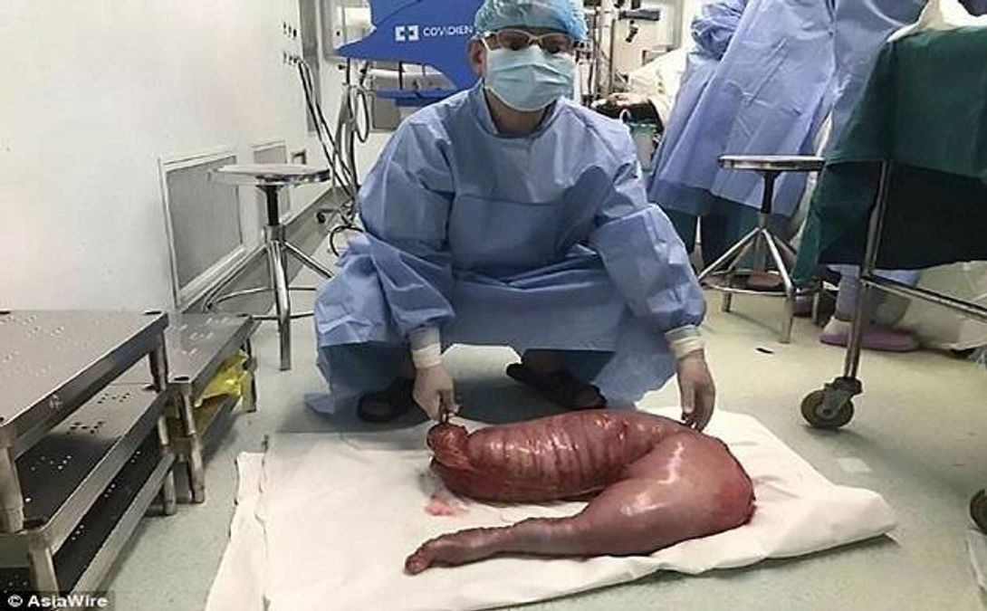 Shocking! Man constipated since birth, doctors remove 13 Kgs of feces ...