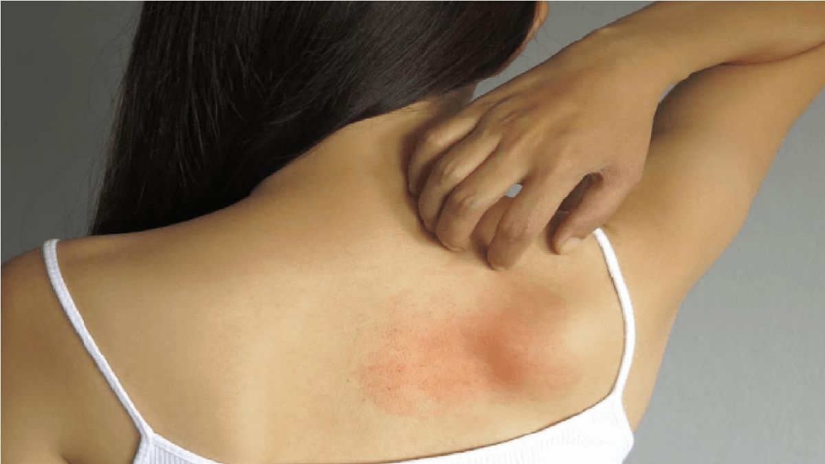 गर्मियों में घमौरियों से हैं परेशान तो छुटकारा पाने के लिए इन चीजों का ...