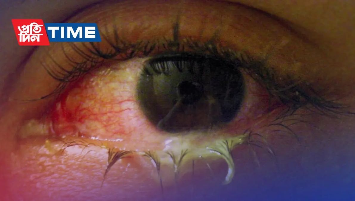 'Madras Eye' Cases Rising: 1.5 Lakhs Cases Recorded In Tamil Nadu