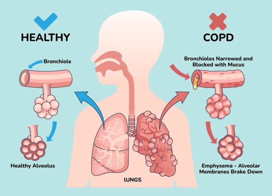 Breathe Easy: Know COPD Before It Stops You